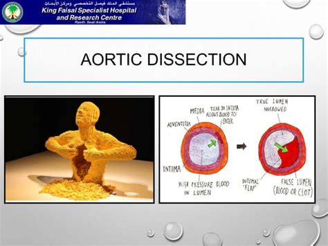 Aortic Dissection Pathophysiology Risk Incidence Types And Treatment Moh D Sharshir PPTX