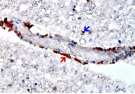 Goran Grujic On Linkedin Multifocal Necrotizing Encephalitis After