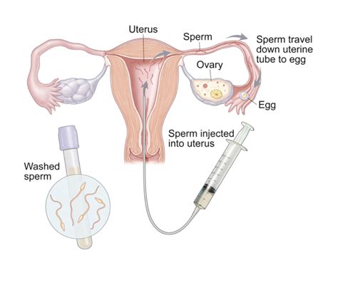 Intrauterine Insemination Iui What It Is And How It Works Androcare Fertility Centre