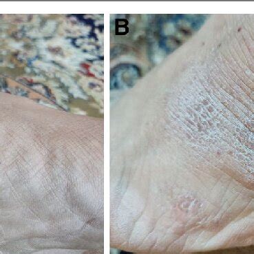 Palmoplantar Pustulosis Ppp Small Monomorphic Pustules On Both Palms