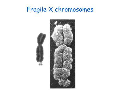 Ppt Fragile X Syndrome Powerpoint Presentation Free Download Id1138412