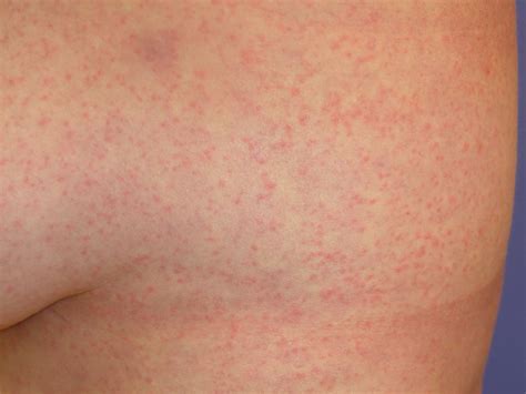 Rash From Over Wiping At Aron Desrochers Blog