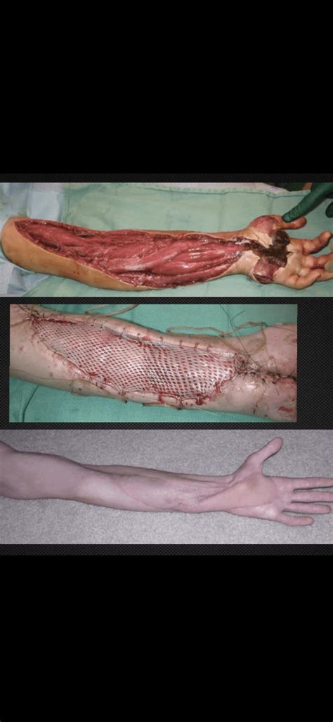 Snake Bite Victim Gets Skin Graft Over Removed Necrosis Area Rnsfl