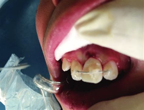 Splinting Of The Avulsed Tooth With Orthodontic Wire And Composite Resin Download Scientific