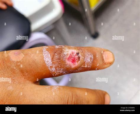 An Abscess That Was Drained From Pus And Cleaned Surgically For