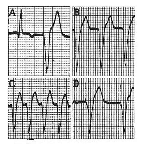 Exam 1 Ecg Conduction Abnormalities I And Ii Flashcards Quizlet