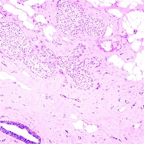 Th E Focus Of Columnar Cell Hyperplasia Surrounded By Tubular Carcinoma