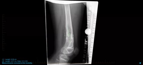 Sarcoma De Ewing En Adultos