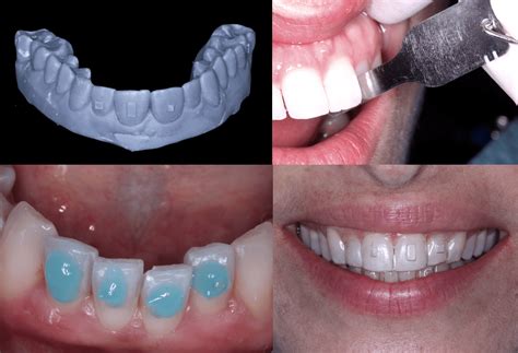 I Like To Move It Move It In Office 3d Printed Aligners With Archform And Moonray Digital Enamel