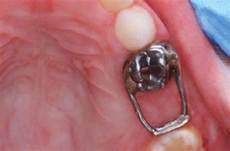 Dental Distal Shoe At Katherine Roosa Blog