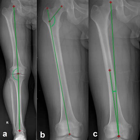 Measurement Of Coronal Alignment A Hka Angle Was Defined As The Angle