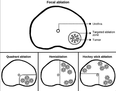 Irreversible Electroporation As A Focal Therapy For Localized Prostate