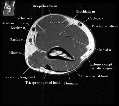 Triceps Anatomy Mri Mri Of Right Arm T1 Weighted Fs Stir Axial Image