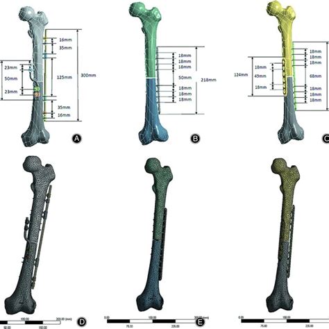 The 3d Model Of Aoota 32‐a32 Fracture With Implants And Their