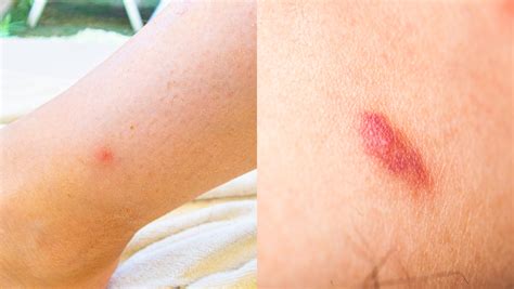 Picadura De Araña Vs Picadura De Chinche Pulga O Chinche Conoce Las