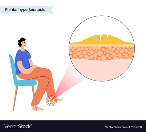 Plantar Hyperhidrosis Poster Royalty Free Vector Image