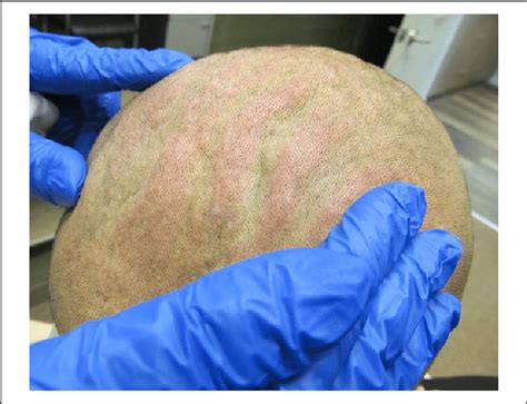 Initial Presentation Of Patient With Cvg Of The Scalp Download Scientific Diagram