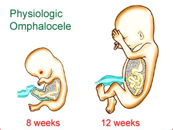 Omphalocele Department Of Obstetrics And Gynecology Faculty Of Medicine Chiang Mai University