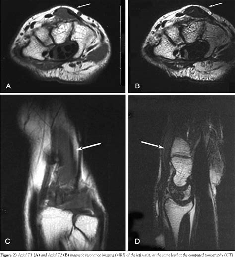Extensor Compartment Radiology At Phoebe Bateman Blog