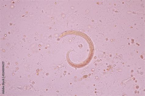 What Are Thread Worms At Alex Ansell Blog