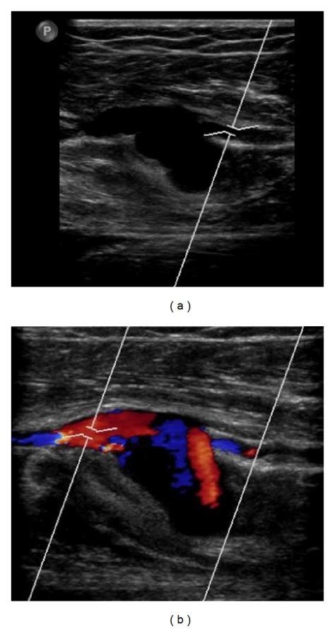 Peroneal Arteriovenous Fistula And Pseudoaneurysm An Unusual Presentation Pmc