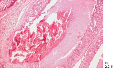 Group 1 One Or Two Clusters Of Crushed Stone Like Calcifications Of The Mammogram Produced By