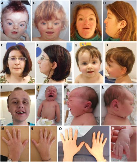 Scientists Discover Rare Genetic Disorder Affecting Families Worldwide