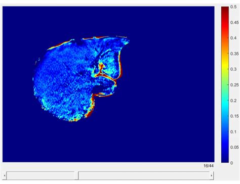 A 3d Quantification Technique For Liver Fat Fraction Distribution Analysis Using Dixon Magnetic