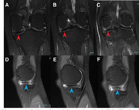 Figure 1 From Arthroscopic Saucerization And Repair Of A Torn Medial