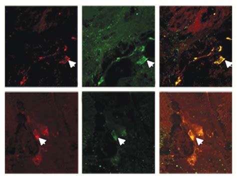 Mcp 1and Mip 1 Expression In Neurons After Stroke Stroked Rat Brain