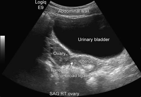 Ovarian Cyst Transabdominal Ultrasound