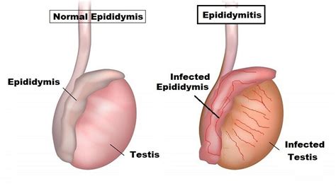 Epididymitis Causes Symptoms And Treatment