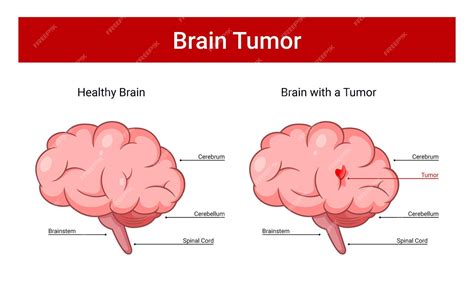 Diagrama Vectorial De Tumor Cerebral Ilustración De Cerebro Sano Y