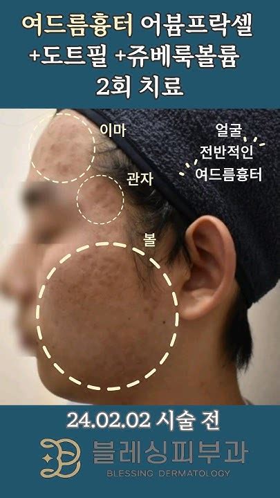여드름흉터 2회 치료로 만족도max 여드름흉터치료 프락셀 도트필 쥬베룩 쥬베룩볼륨 쇼츠 Shorts Youtube