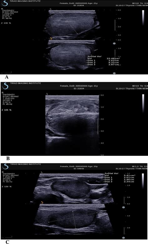 A Thyroid Nodule Size Before Rfa Treatment B Rfa Procedure On Thyroid
