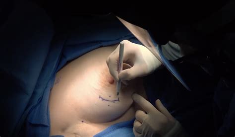 What Happens During A Lumpectomy And Sentinel Node Biopsy
