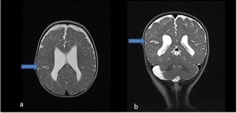 Unilateral Opercular Polymicrogyria In A Girl With 22q13 Deletion Syndrome Open Access