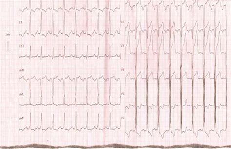 Figure 1 From A Young Male Patient With Subaortic Membranous Stenosis