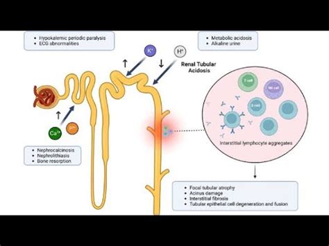 Nefritis Tubulointersticial
