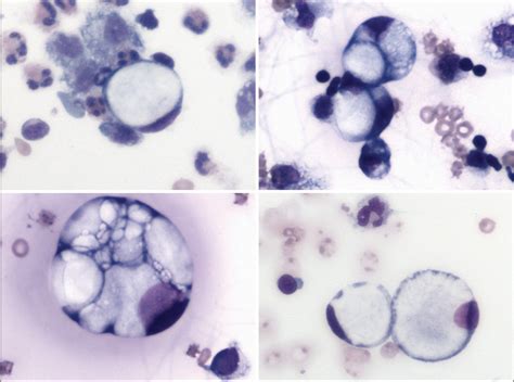 Signet Ring Cells In Pleural And Peritoneal Effusions Identified On