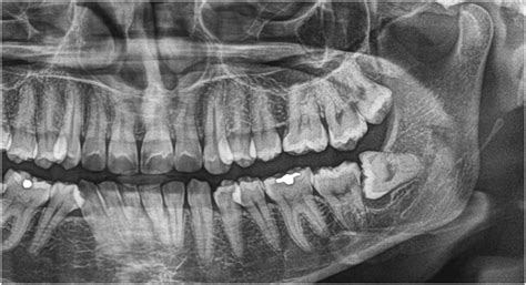 All About Wisdom Teeth Pain Causes Impaction And Removal Process