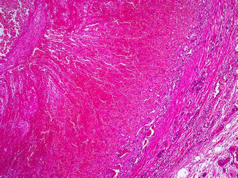 004aorganizing Thrombus