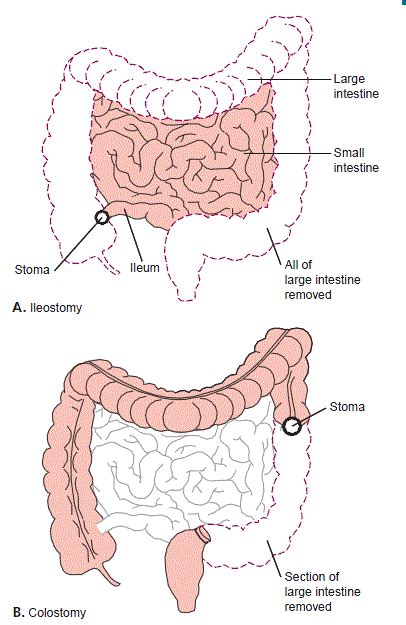 Pre And Non Cancerous Bowel Conditions Grace Gawler Cancer