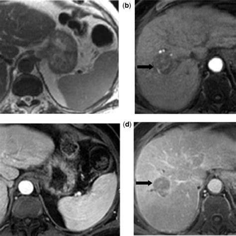 Needle Biopsy Of The Segment 8 Liver Lesion Revealed Two Discrete Download Scientific Diagram