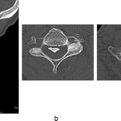 Preoperative Cervical Ct Scan Preoperative Cervical Ct Scan Revealed
