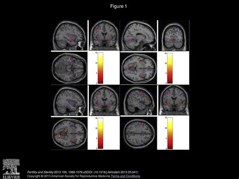 Brain Activation Patterns In Women With Acquired Hypoactive Sexual Desire Disorder And Women