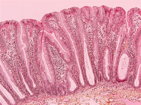 Computer Aided Diagnosis May Aid In Characterizing Colorectal Lesions