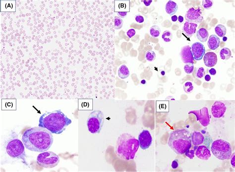 A Peripheral Blood Showing Normochromic Red Cells With Some