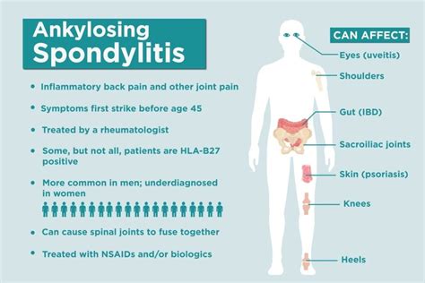 Ankylosing Spondylitis Chiswick Physio