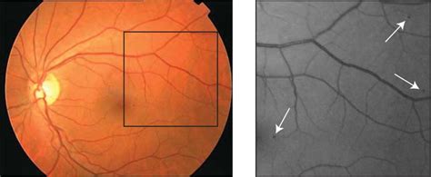 Digital Color Fundus Photograph Containing Microaneurysms This Image Download Scientific